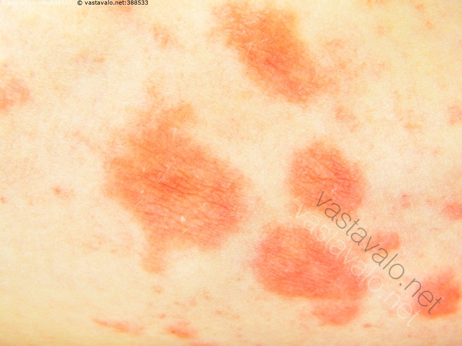 Kuva: Ihottuma - iho ihottuma sairaus nokkosihottuma urtikaria ...